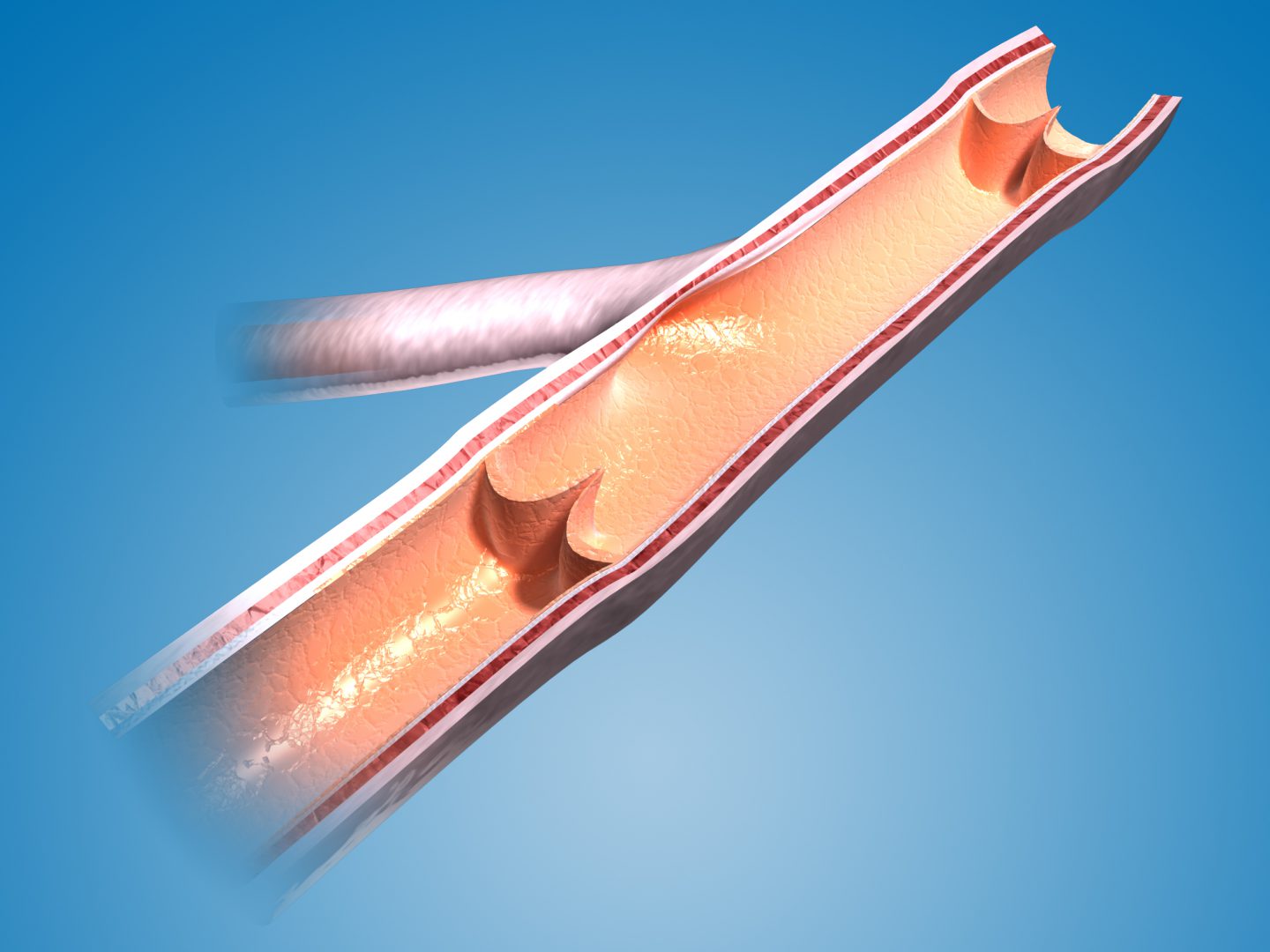 Venous valves - MedicalGraphics