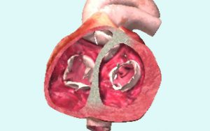 Myokardinfarkt Video - MedicalGraphics