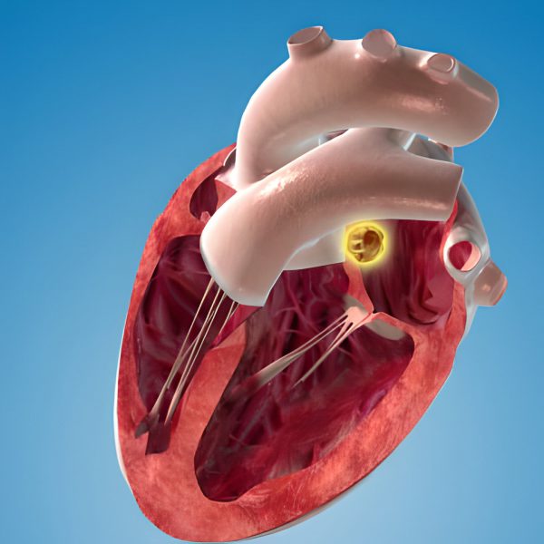Thrombus in left atrium - MedicalGraphics