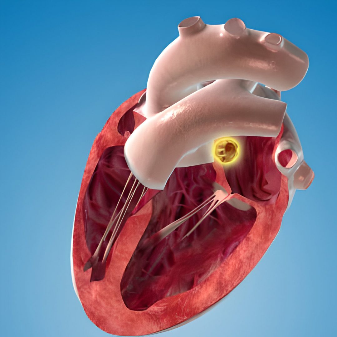Animation Vorhofthrombus - MedicalGraphics