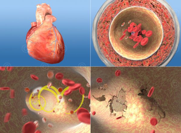 Animations Tunica media in arterial hypertension - MedicalGraphics