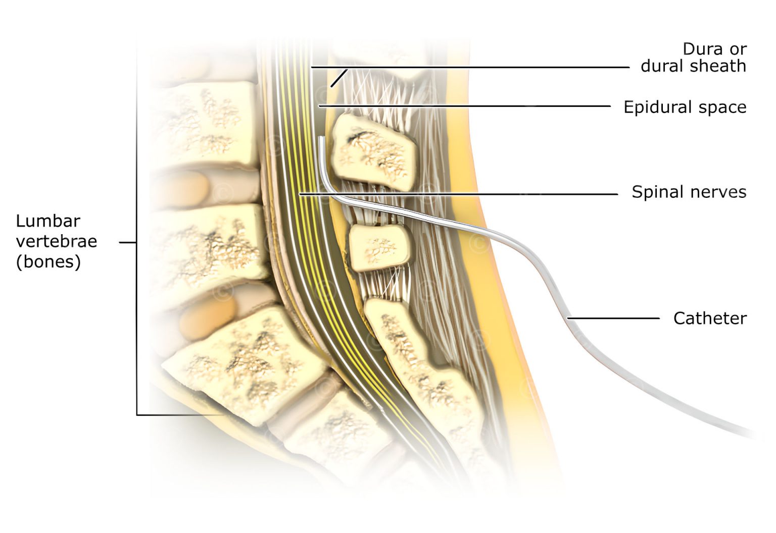Illustration peridural anesthesia - MedicalGraphics