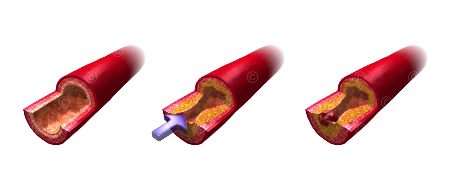Illustration stenosis - MedicalGraphics