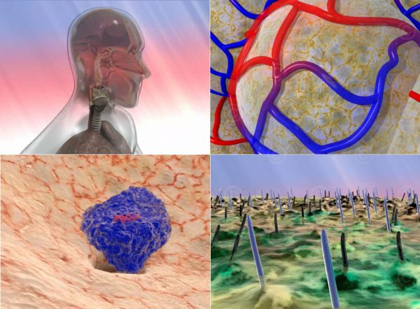 Animation respiratory diseases - MedicalGraphics