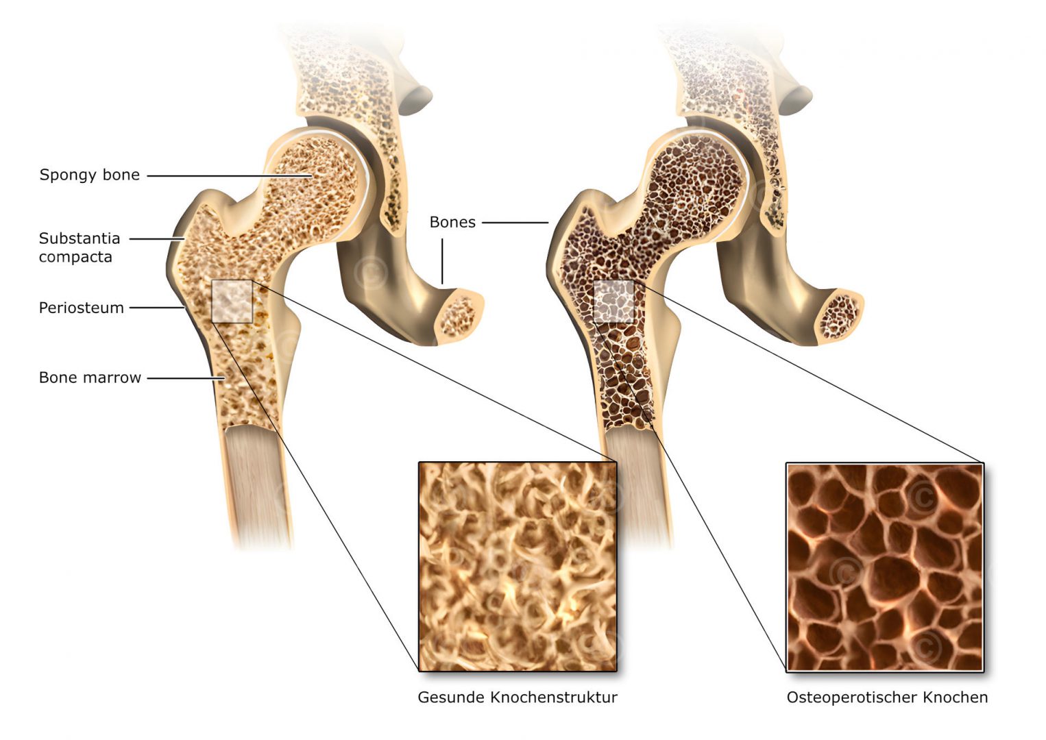 Illustration osteoporosis - MedicalGraphics