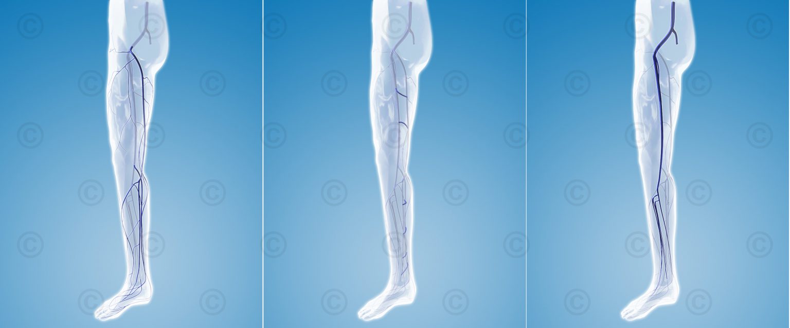 Animation Venen Bein - MedicalGraphics
