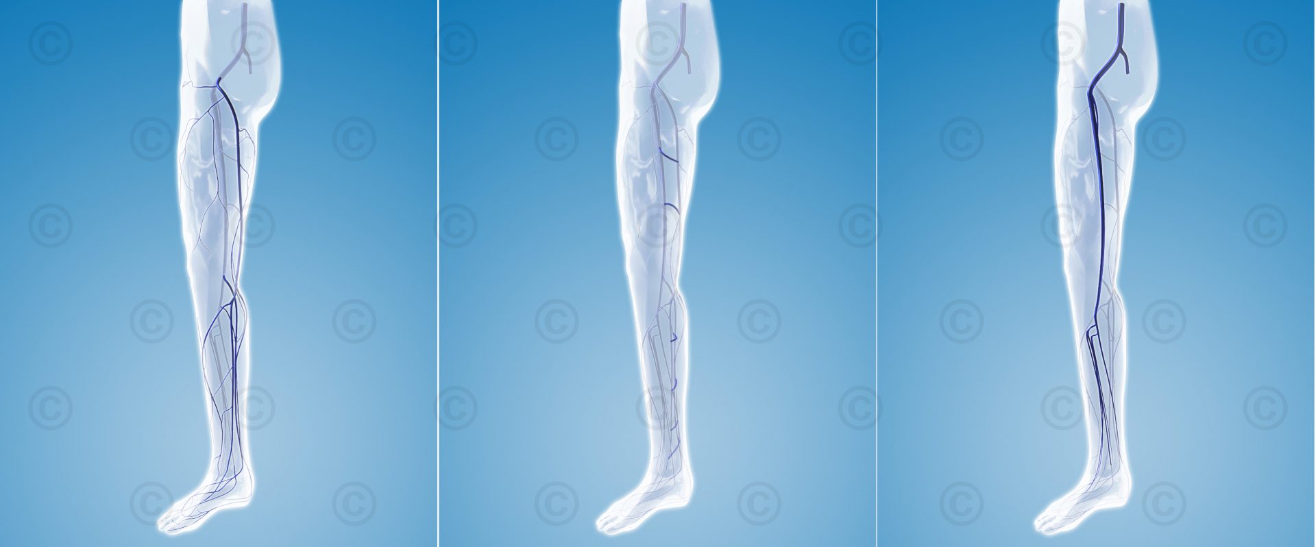 Animation leg veins - MedicalGraphics