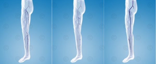 Animation leg veins - MedicalGraphics