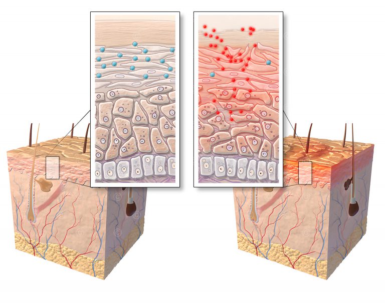 Illustration atopic dermatitis - MedicalGraphics