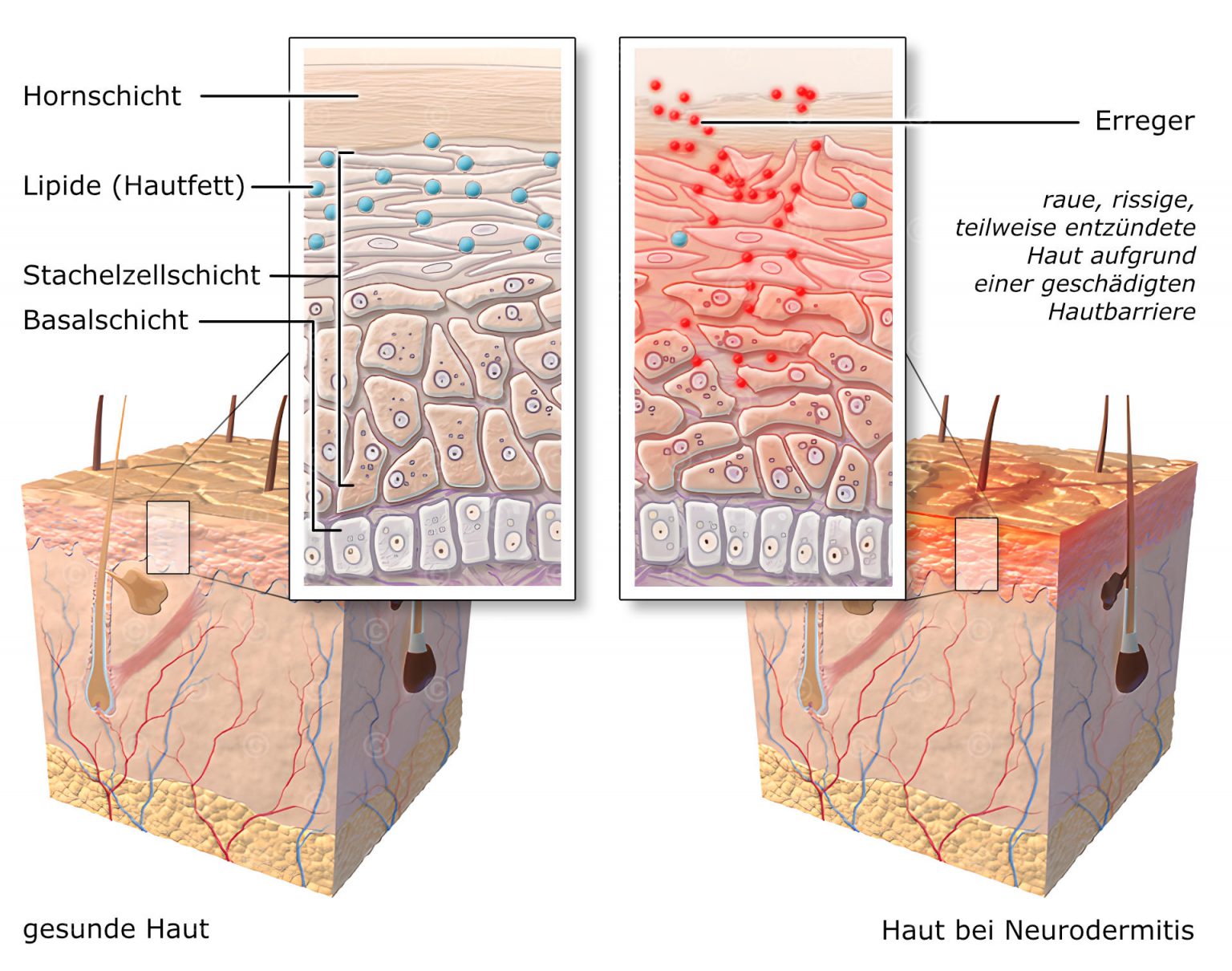 Illustration Neurodermitis - MedicalGraphics