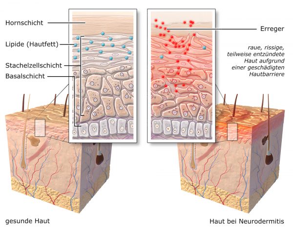 Illustration Neurodermitis - MedicalGraphics