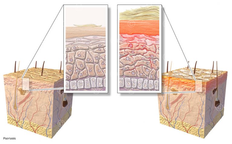 Illustration changes in psoriasis - MedicalGraphics