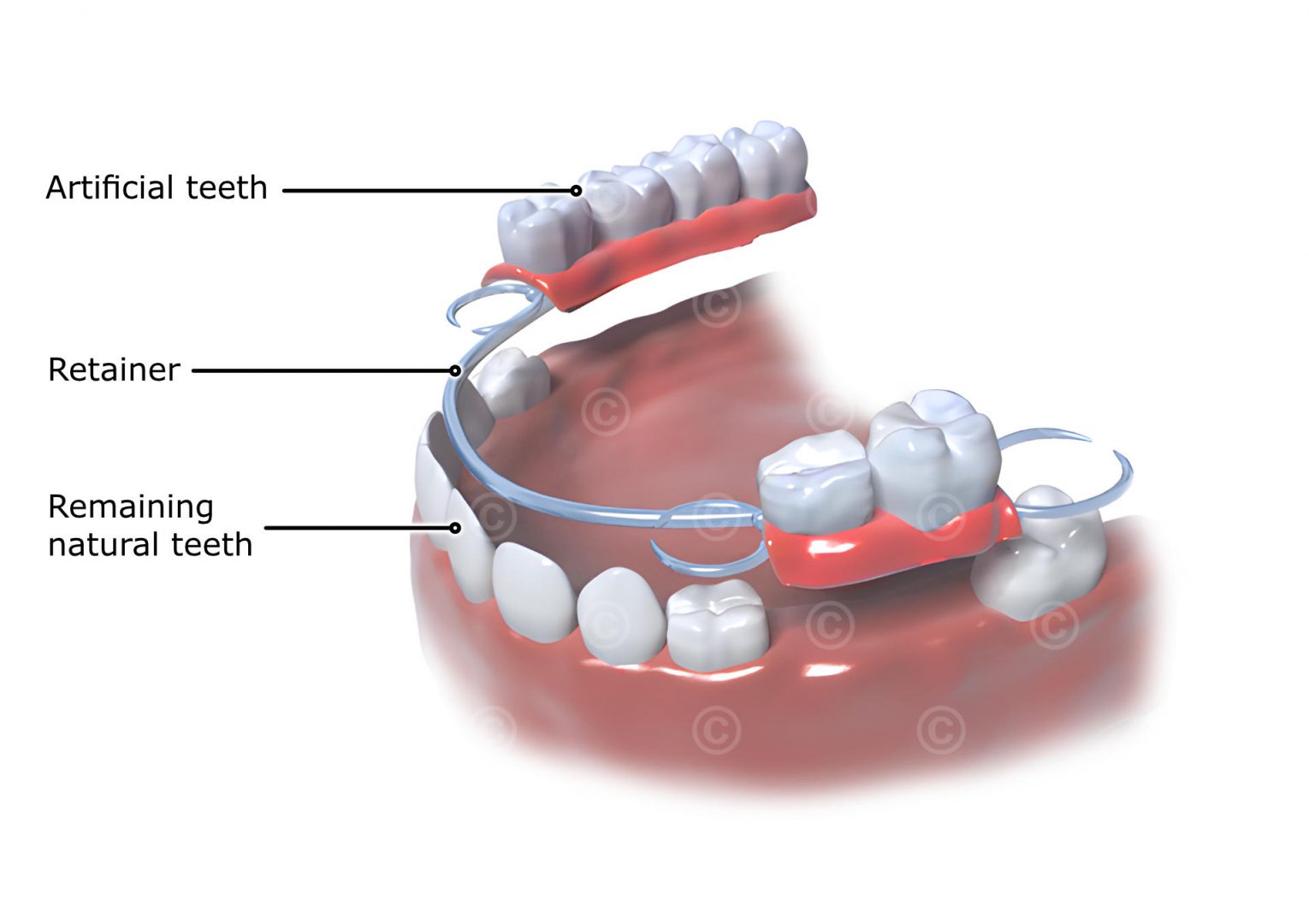Illustration dental prosthesis - MedicalGraphics