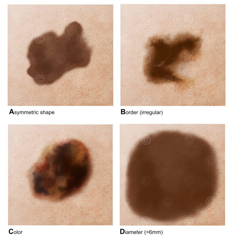 Illustrationen check-up melanoma - MedicalGraphics