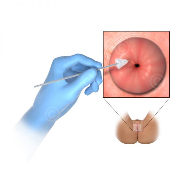 Illustration Pap Smear Medicalgraphics
