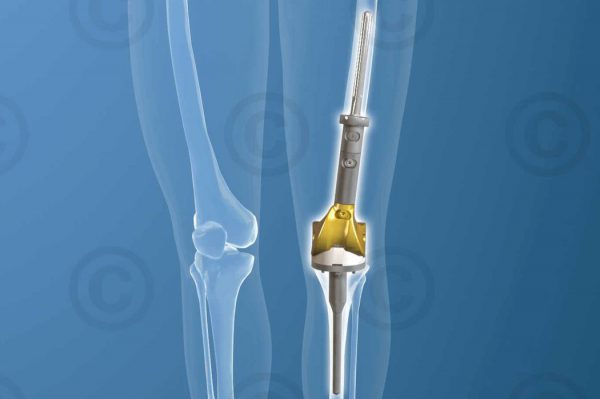 Illustrationen orthopädische Implantate - MedicalGraphics