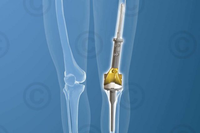 Illustrationen orthopädische Implantate - MedicalGraphics