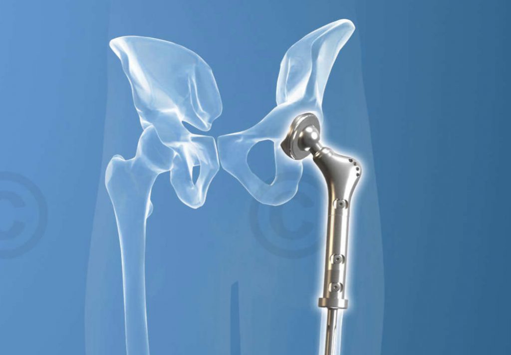 Illustrationen orthopädische Implantate - MedicalGraphics