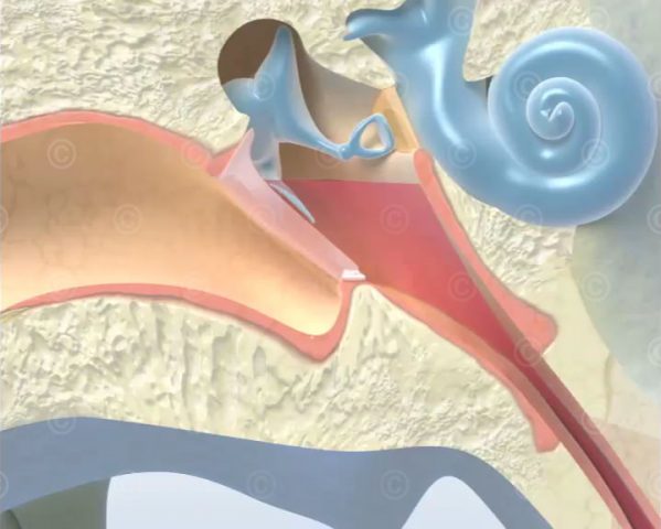 Animation Mittelohrentzündung bei Kindern - MedicalGraphics