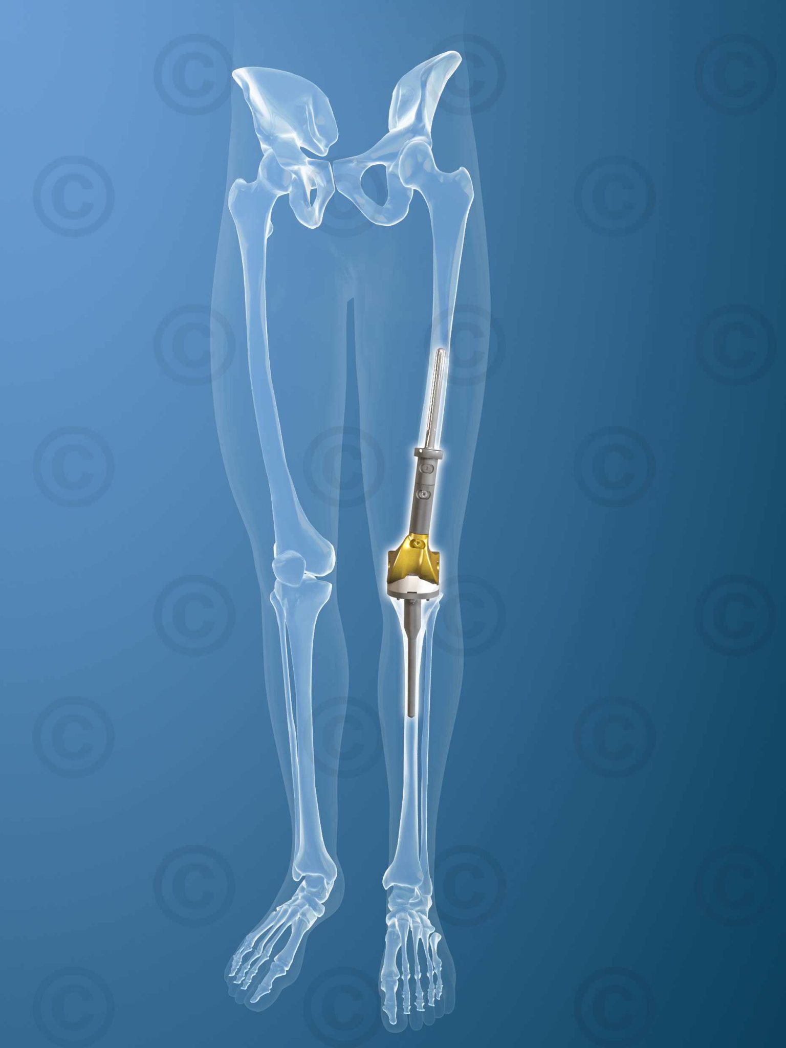Illustration of orthopedic implants - MedicalGraphics