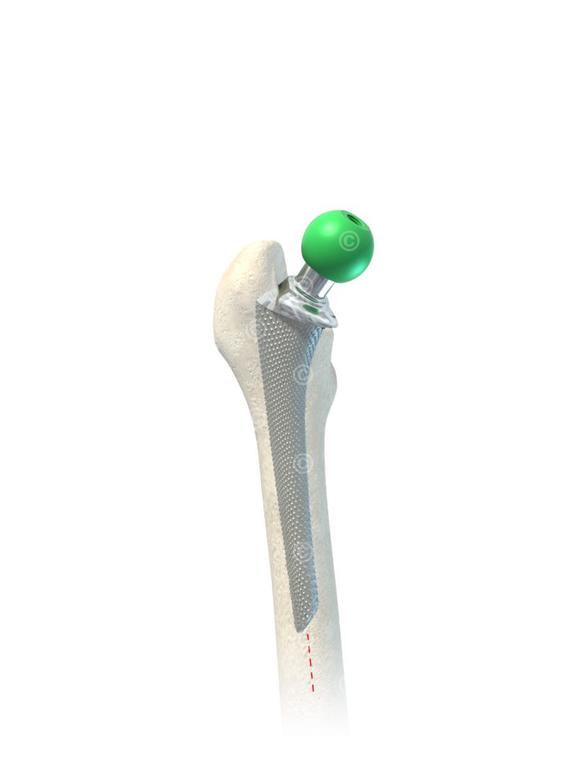 Illustration orthopädische OP-Anleitung - MedicalGraphics