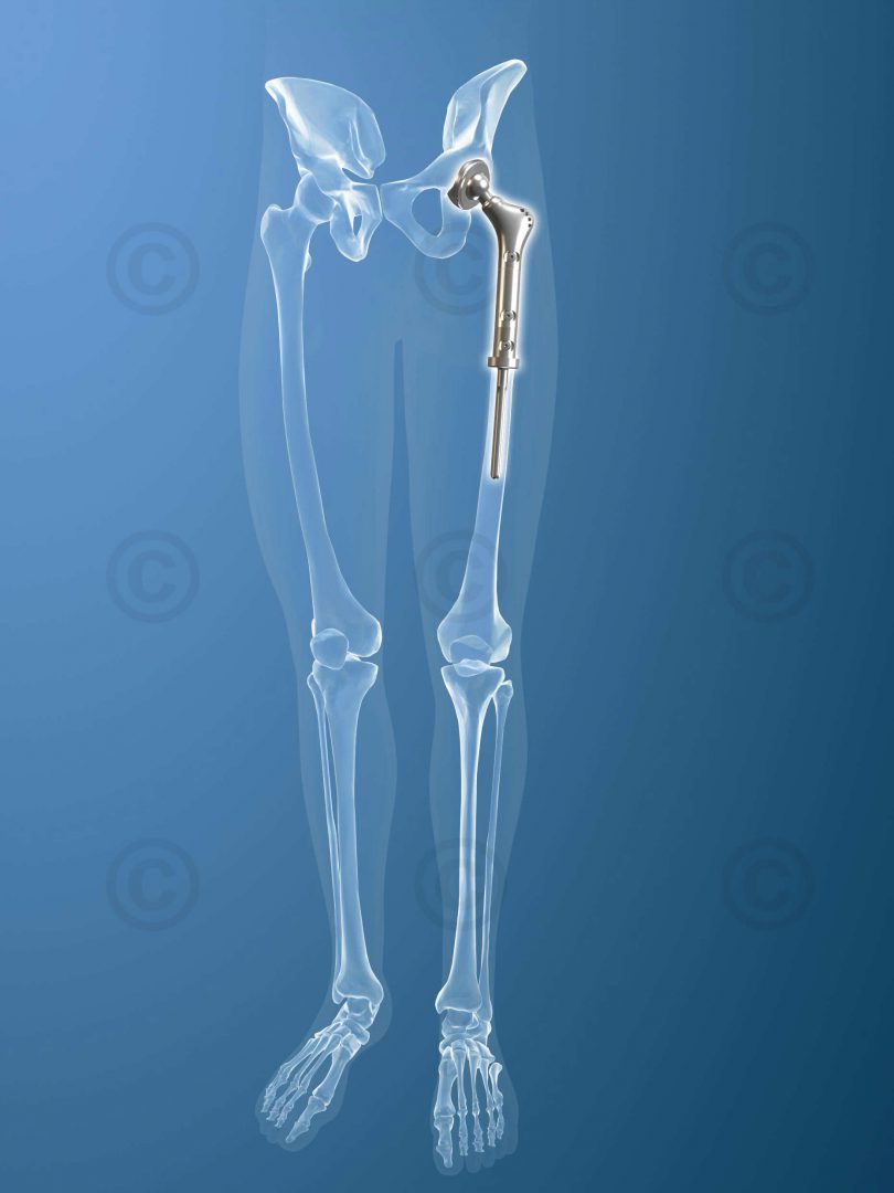 Illustration of orthopedic implants - MedicalGraphics