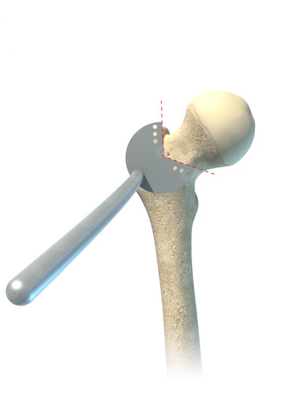 Illustration orthopädische OP-Anleitung - MedicalGraphics