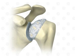Arthrose des Schultergelenks - MedicalGraphics