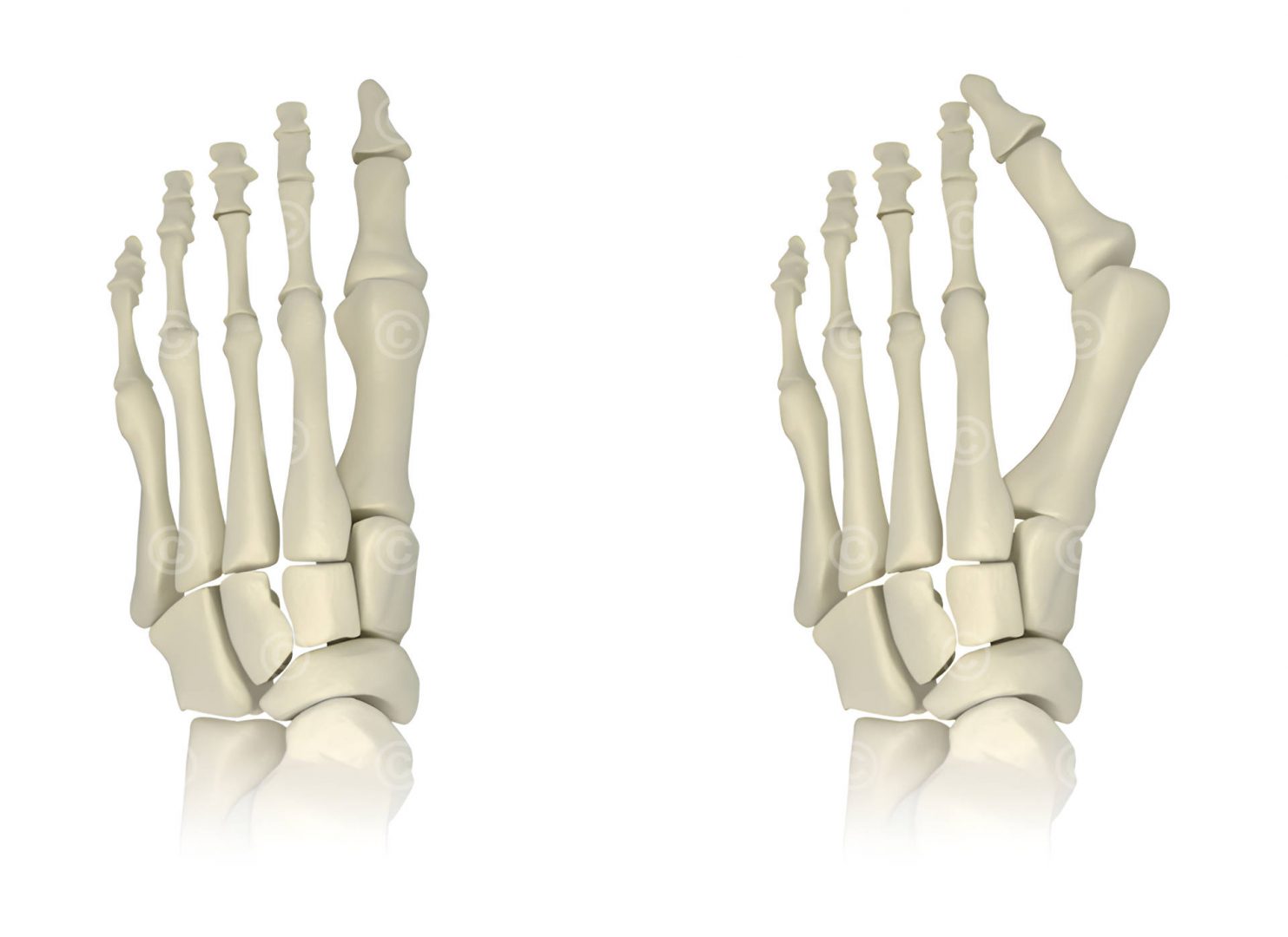 Illustration Fehlstellung Hallux Valgus - MedicalGraphics
