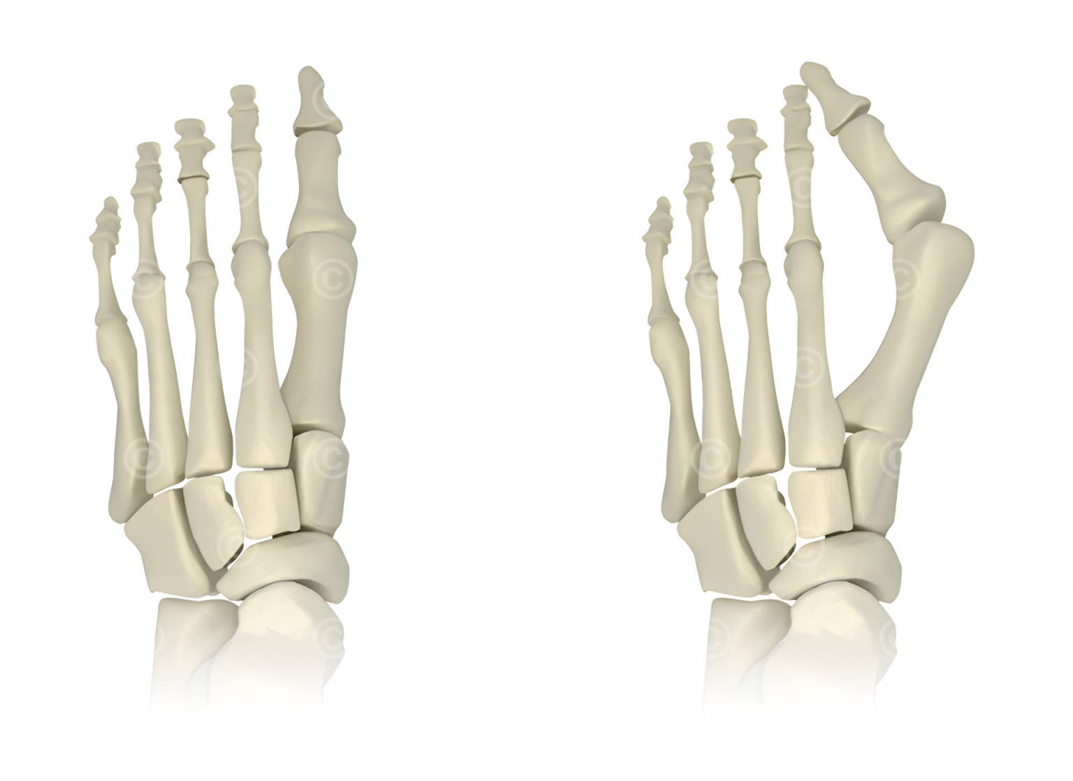 Illustration hallux valgus - MedicalGraphics
