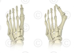 Illustration hallux valgus - MedicalGraphics