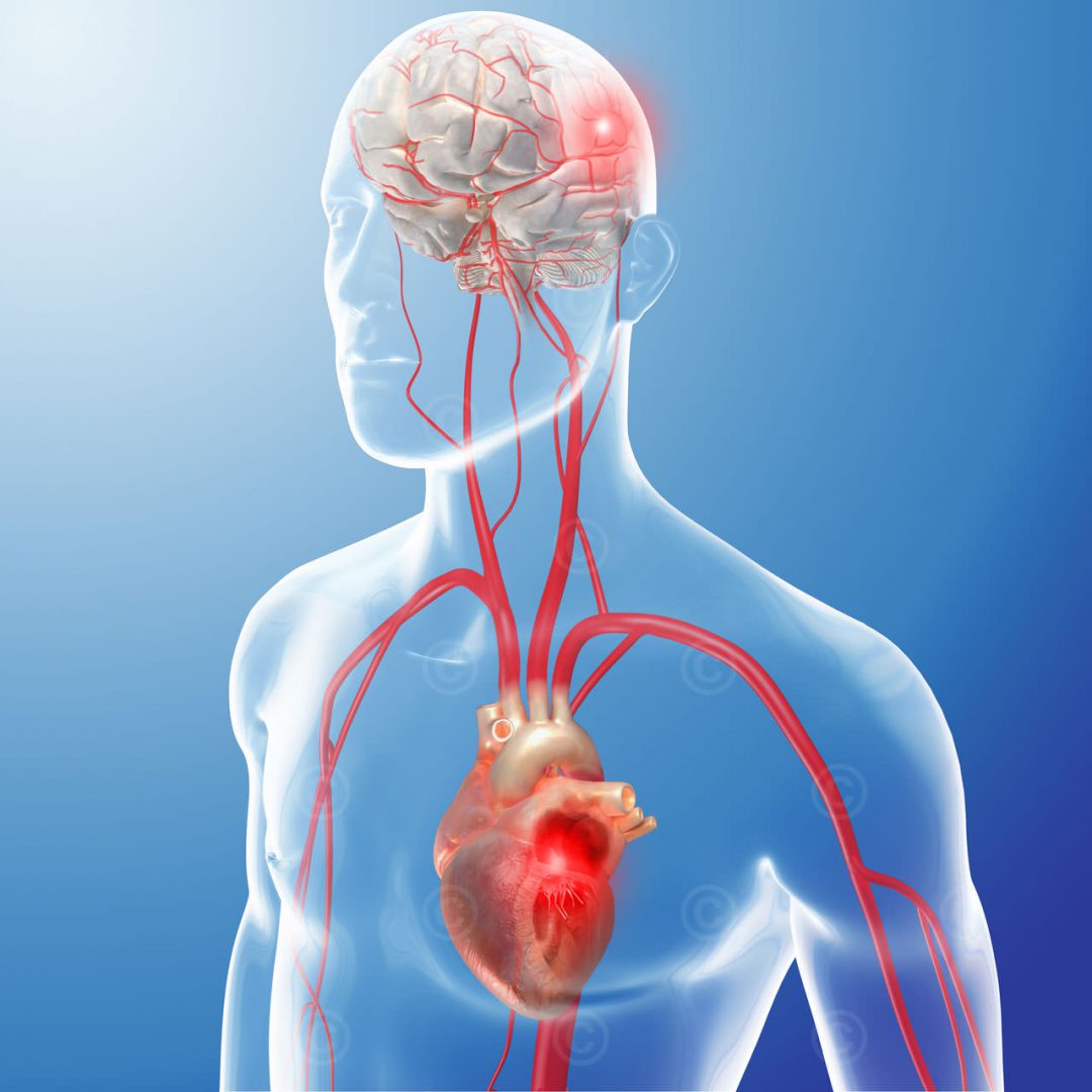 Key-visual stroke - MedicalGraphics