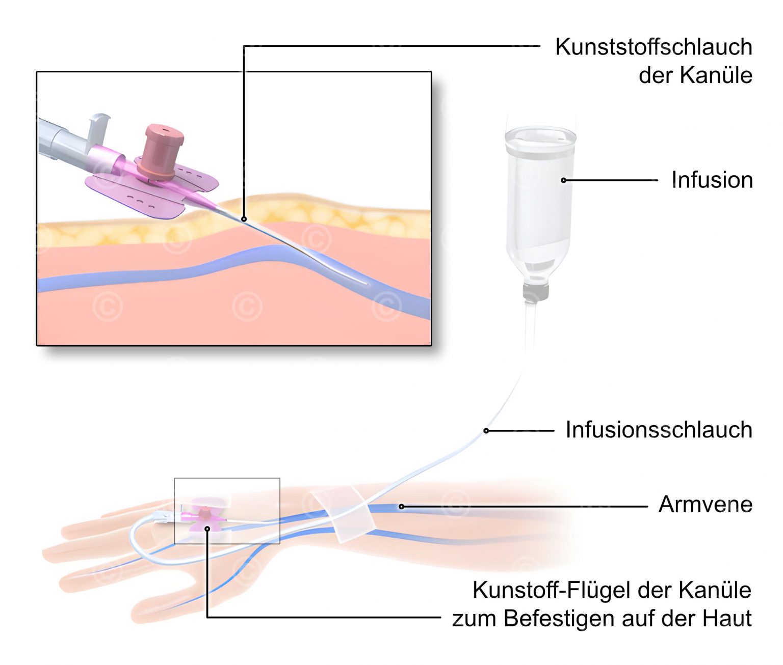Illustration Infusion - MedicalGraphics