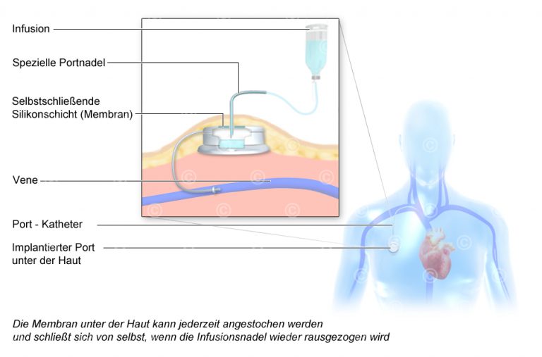 Illustration port catheter - MedicalGraphics