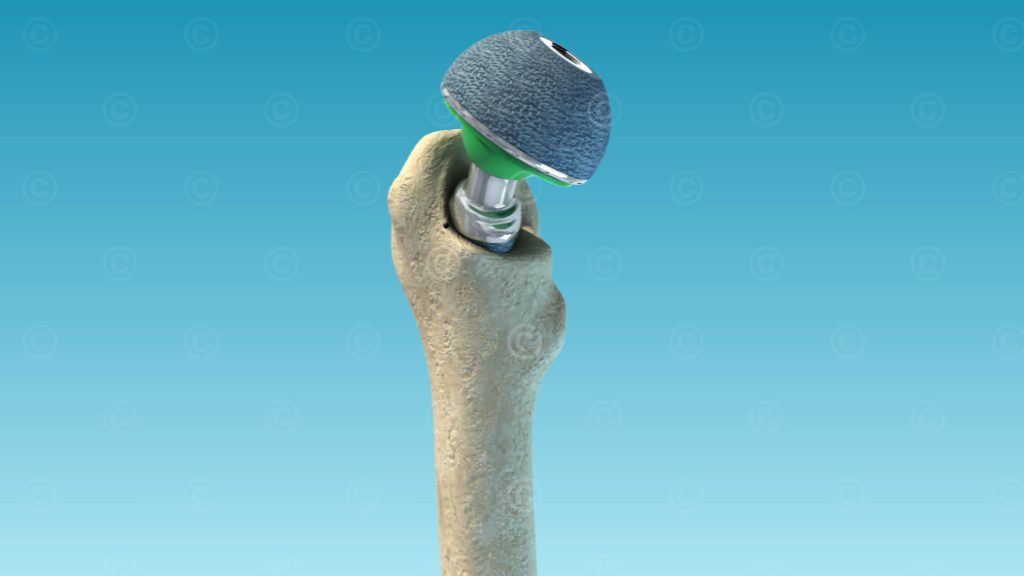 Animation hip replacement - MedicalGraphics