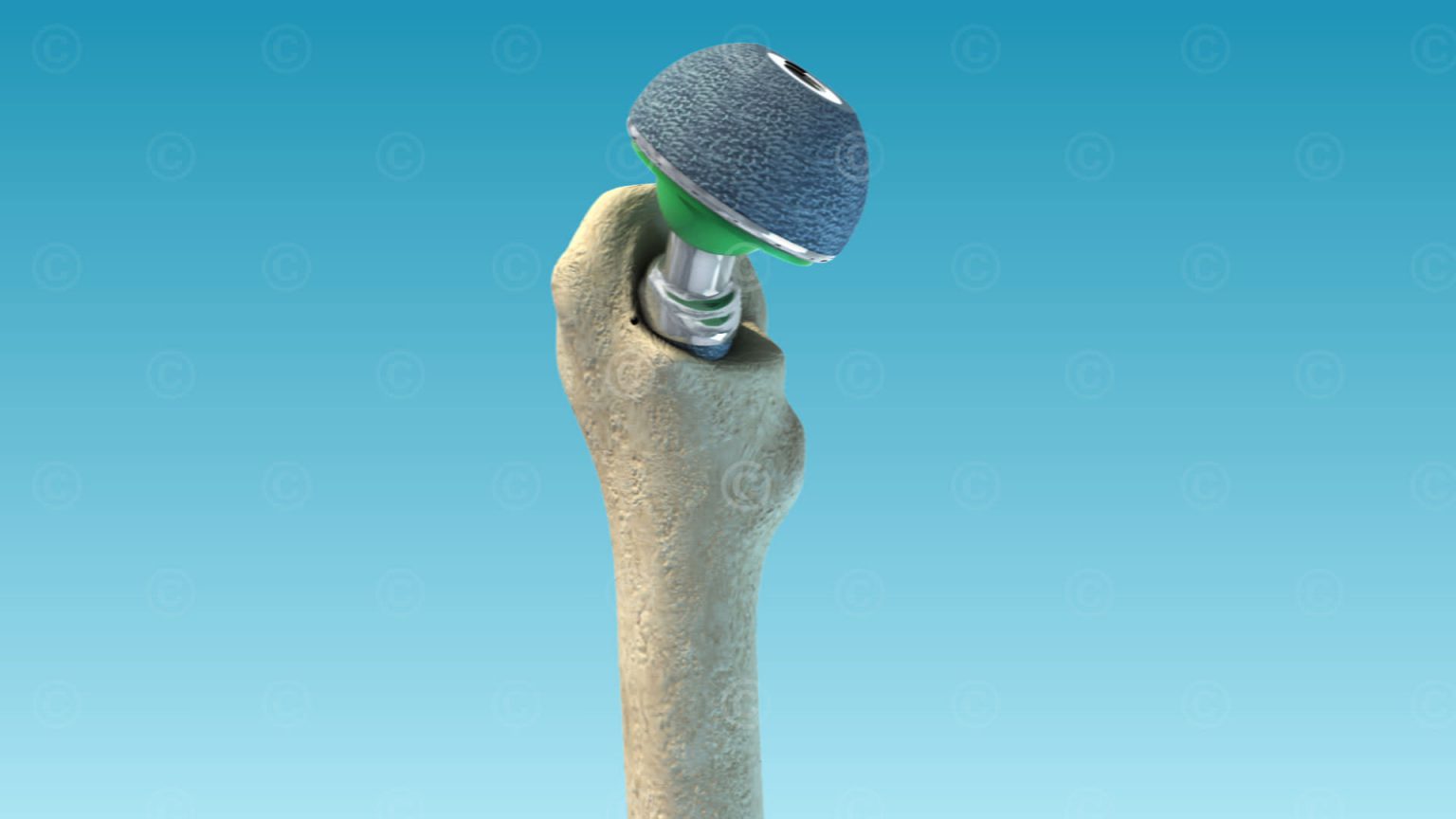 Animation hip replacement - MedicalGraphics