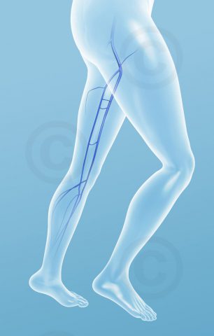 Medical key-visuals "Biolitec" - MedicalGraphics