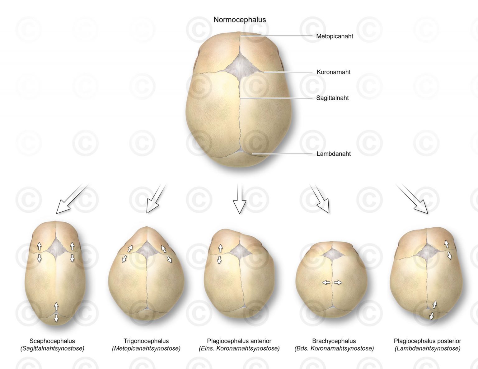 Illustration Kraniosynostose - MedicalGraphics