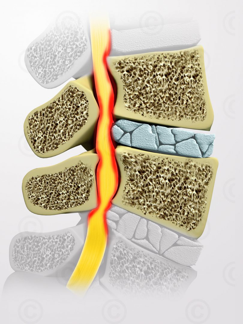 Medical illustrations "Causes of back pain" - MedicalGraphics