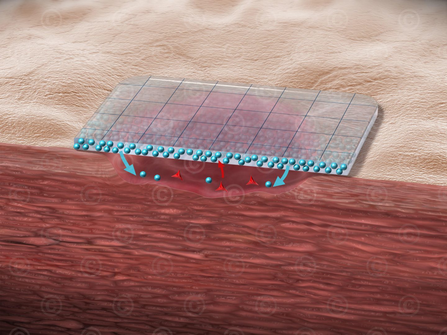 Animation wound dressing HydroTac transparent - MedicalGraphics