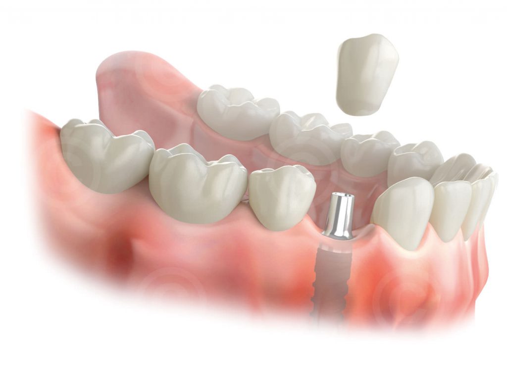 3D animation dentures and implantology - MedicalGraphics