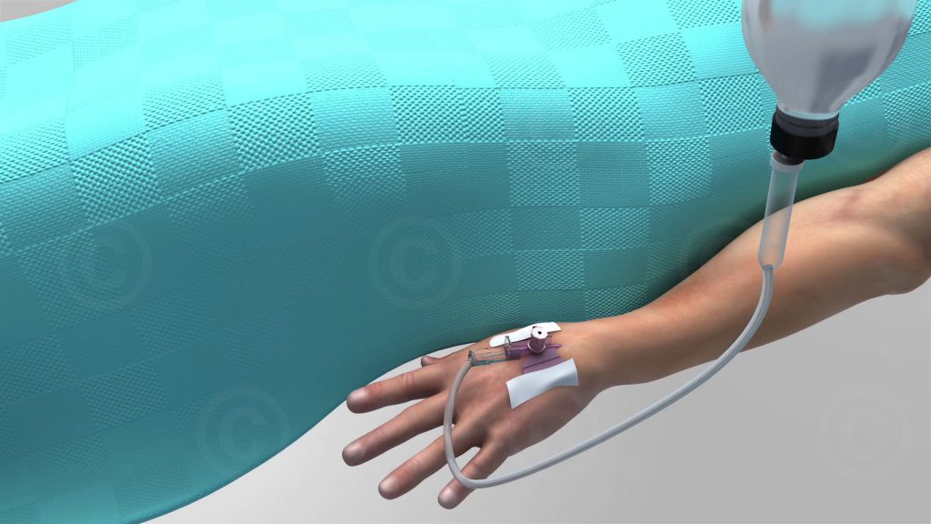 Medical animation anesthesia - MedicalGraphics