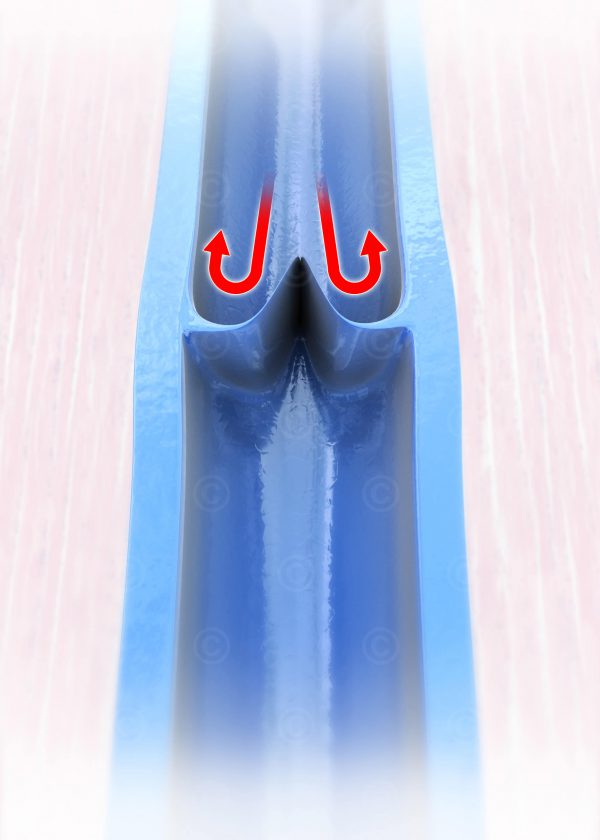 Illustrations disorders of the venous valves - MedicalGraphics