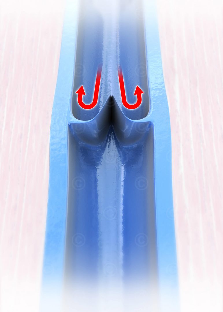 Illustrations disorders of the venous valves - MedicalGraphics