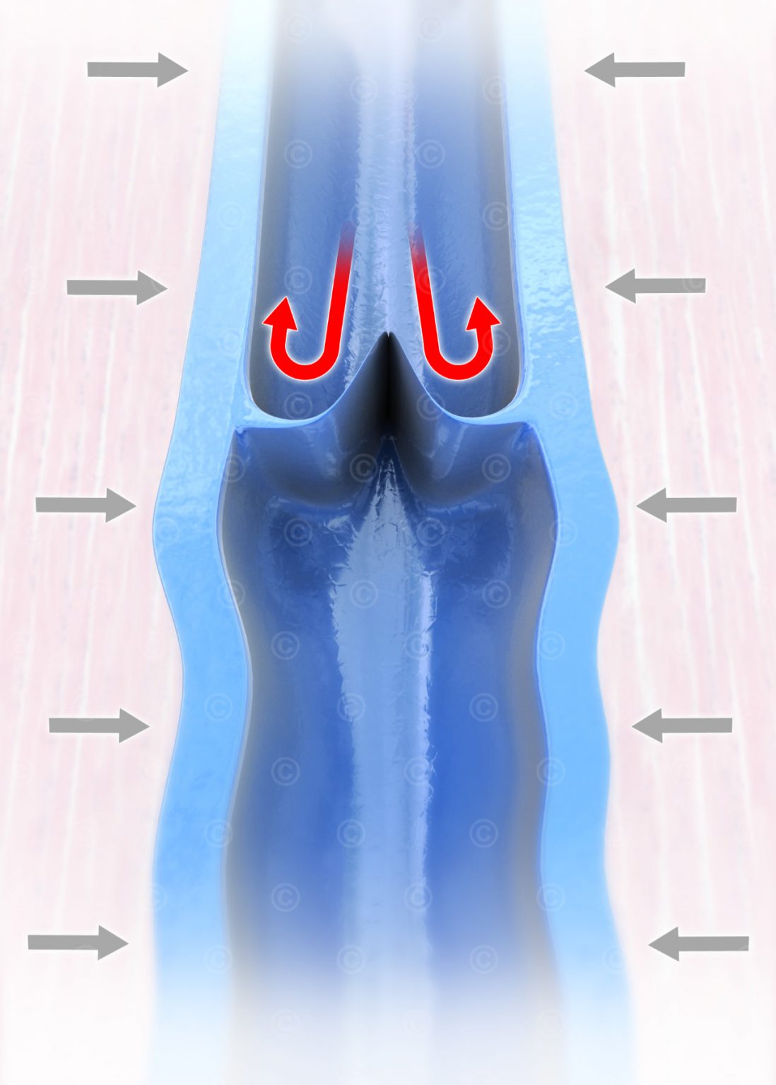 Illustrationen Erkrankungen der Venenklappen - MedicalGraphics