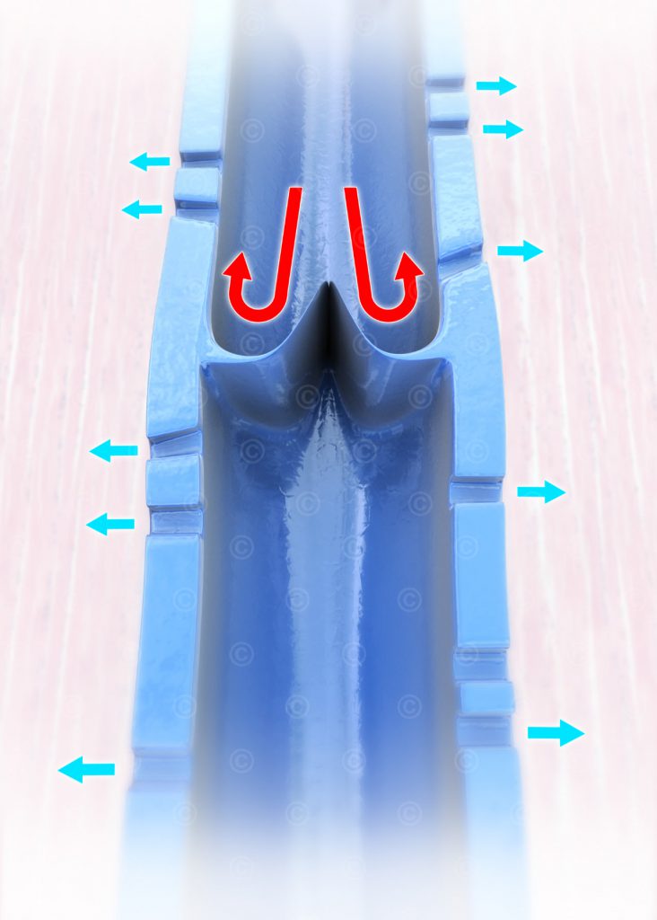 Illustrationen Erkrankungen der Venenklappen - MedicalGraphics