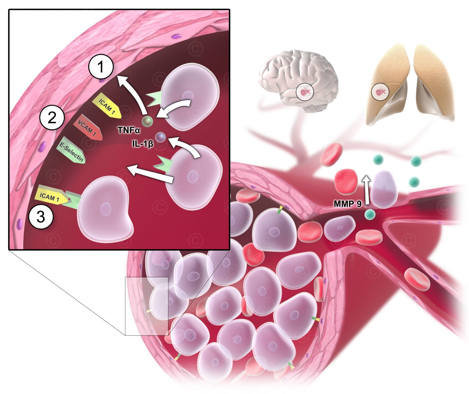 Illustration zur Pathogenese der Leukostase - MedicalGraphics
