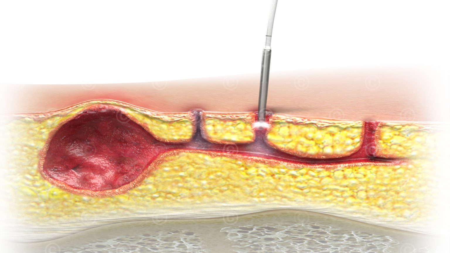Illustration Behandlung Pilonidalsinus - MedicalGraphics