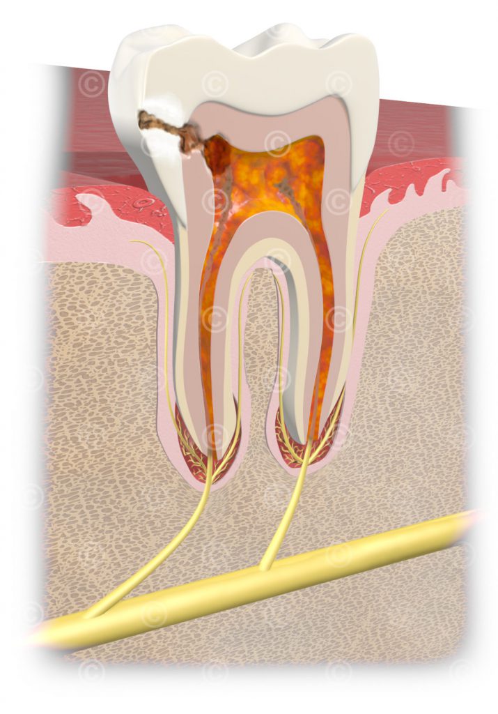Illustrationen Wurzelspitzen-Entzündung - MedicalGraphics
