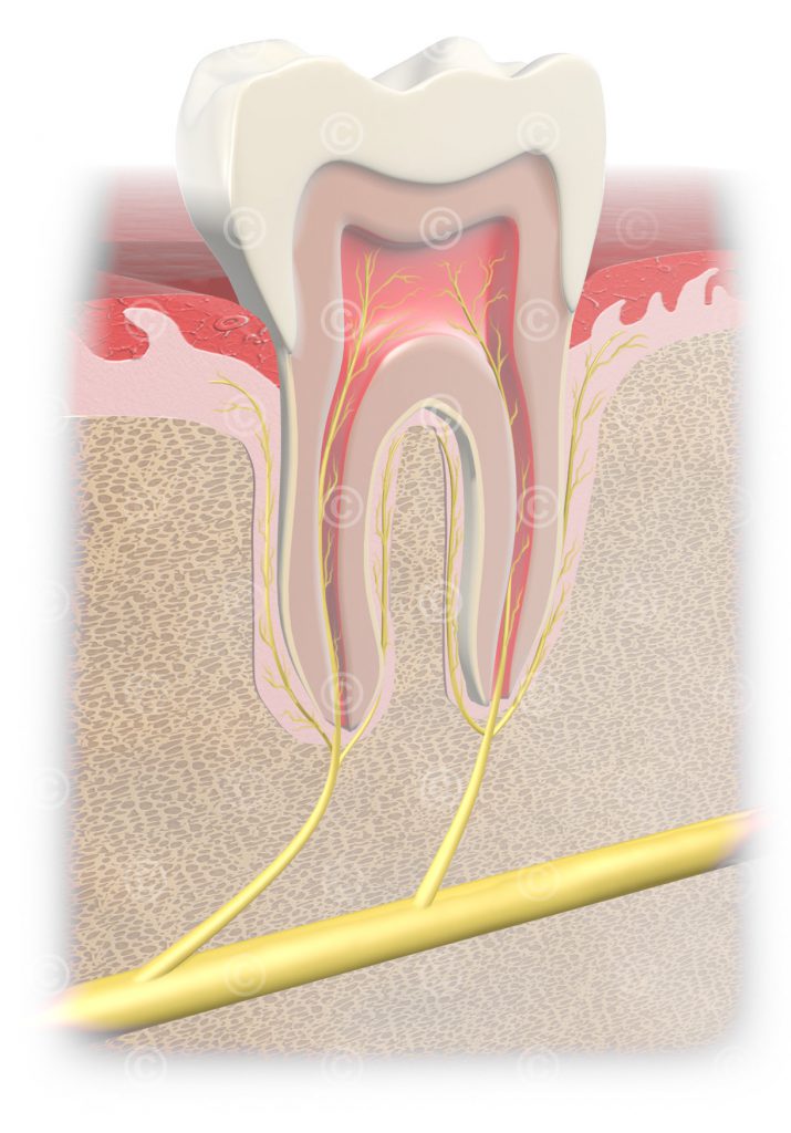 Illustrationen Wurzelspitzen-Entzündung - MedicalGraphics